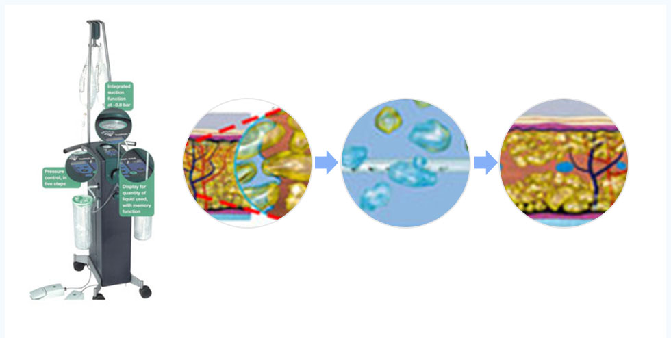 What is Liposuction - TOP CLASS | 탑클래스 성형외과 TOPCLASS PLASTIC SURGERY